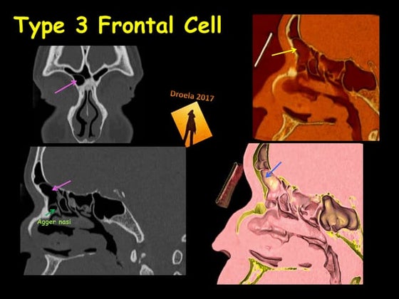 Pulmonary Embolism CT | PPT