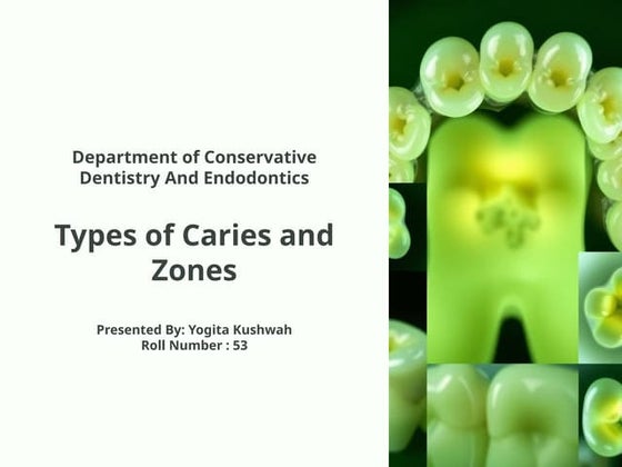 The pathogenesis of dental caries made e | PPT