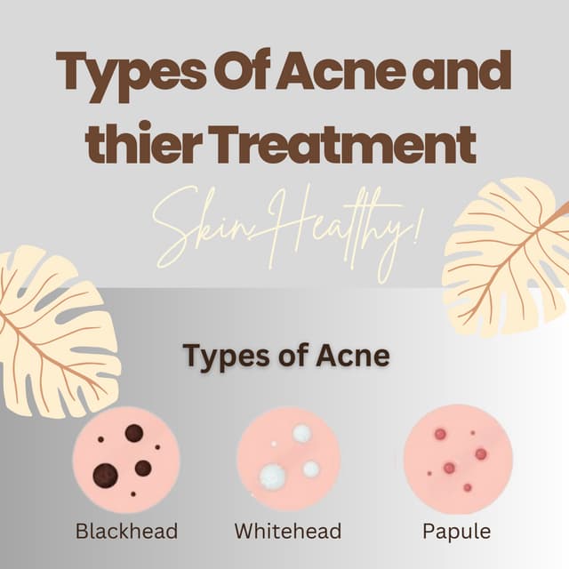 Types of acne and their treatment .pdf
