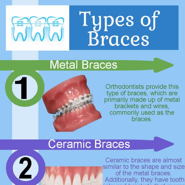 Types of Braces | PDF | Dental Health | Diseases and Conditions