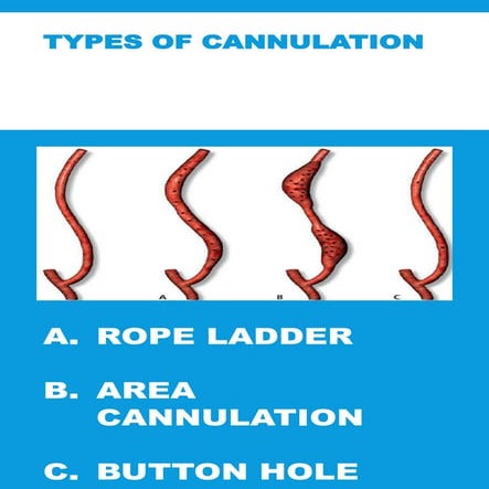 Buttonhole Cannulation Technique Power Point | PPT