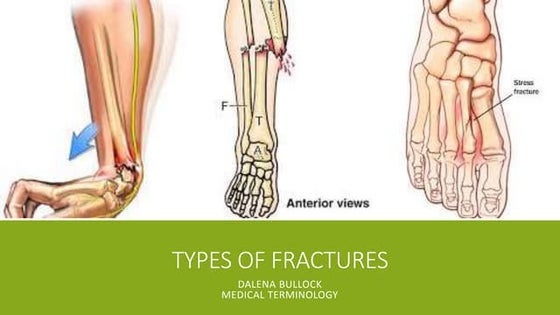 Fractures | PPTX