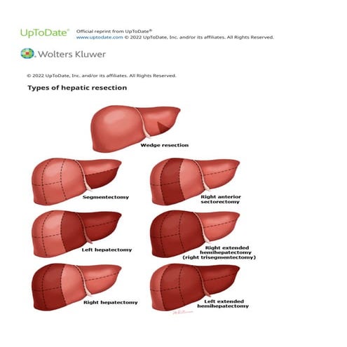 Types of hepatic resection.pdf