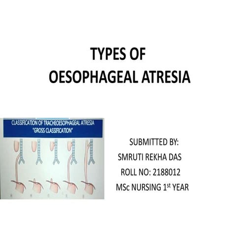 TYPES OF OESOPHAGEAL ATRESIA.pptx