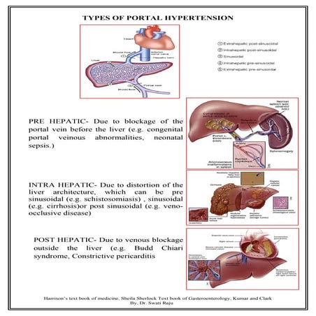 Types of portal hypertension | DOC