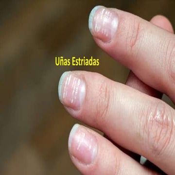Uñas Estriadas Diagnostico y Tratamiento .pptx