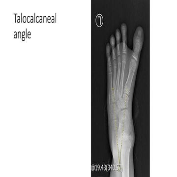 ukuran equinus deformity.pptx