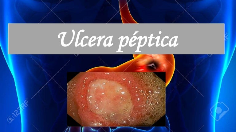 Ulcera péptica