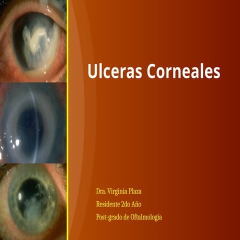 Ulceras Corneales clasificación y tratamiento | PPTX