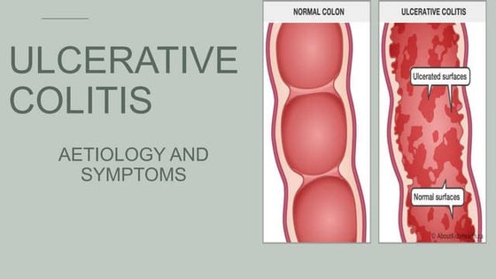 Ulcerative Colitis (UC) | PPT
