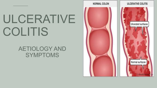 Ulcerative Colitis (UC) | PPTX