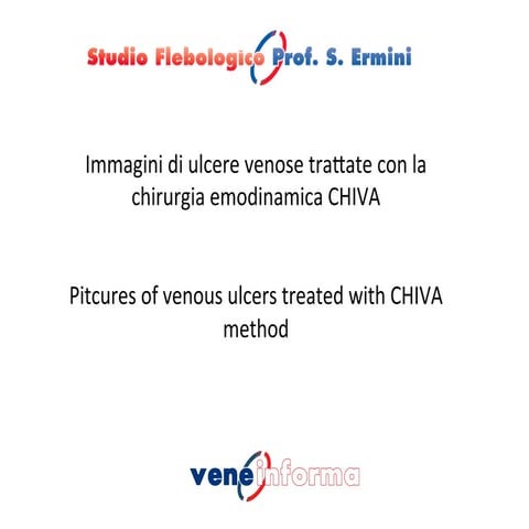 Venous ulcers treated with CHIVA method | PPT