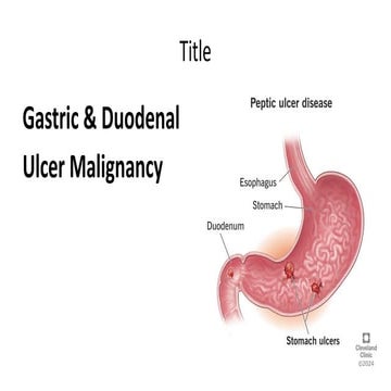 Ulcer_Malignancy_Presentation all about.pptx