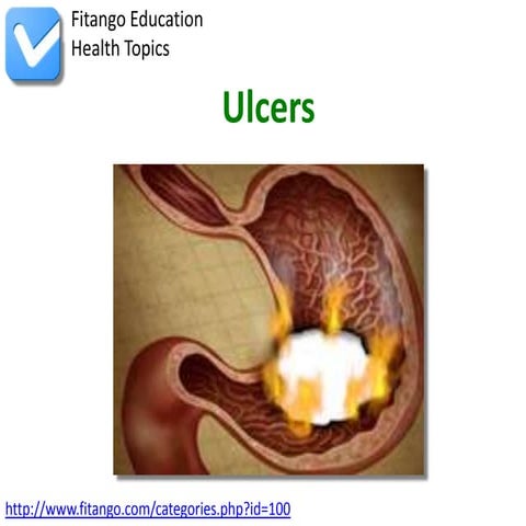 Ulcers | PPTX