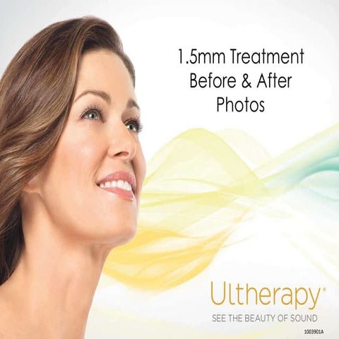 Ulthera Before & After | PPTX