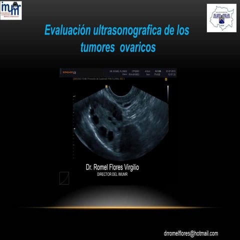 Ultrassonografia De Fibroma Ovariano FIBROTECOMA BILATERAL DE OVARIO