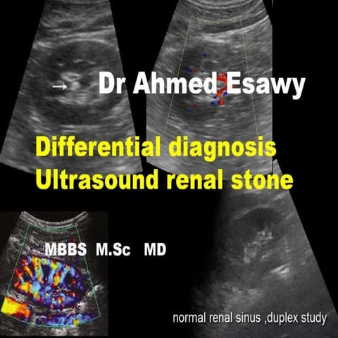 Kidney Renal Ultrasoun On Stone