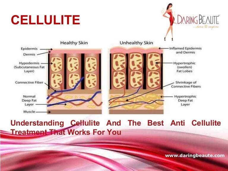 Understanding cellulite and the best anti cellulite treatment that wo…