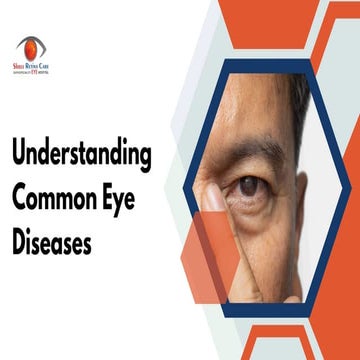 Understanding Common Eye Diseases - - | PPT