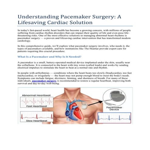 Understanding Pacemaker Surgery A Lifesaving Cardiac Solution | PDF