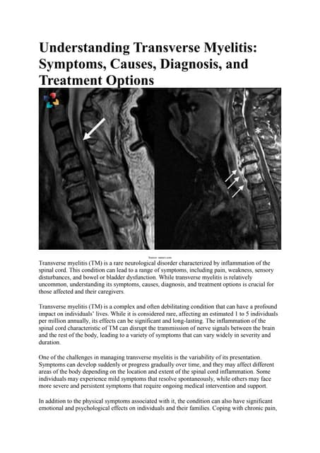 Transverse myelitis | PPTX