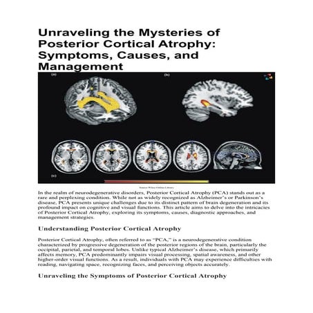 Mysteries of Posterior Cortical Atrophy: Symptoms, Causes, and ...