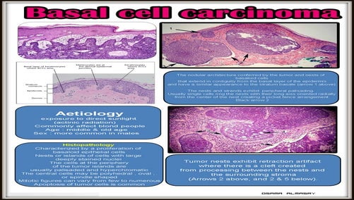 Carcinoma Slide