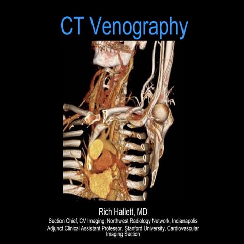 Upper Extrem CT Venography_Hallett_2017_sm.pdf