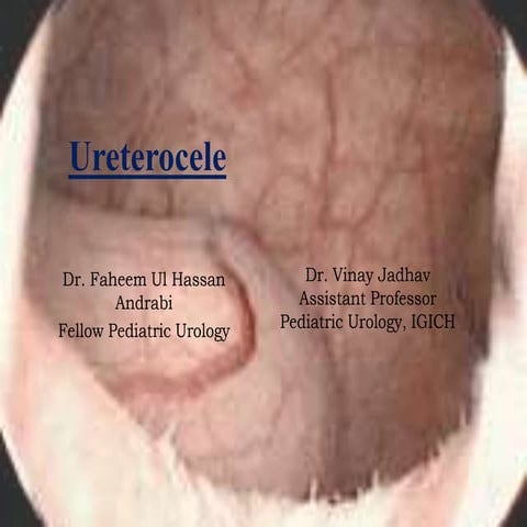 Ureterocele, | PPT