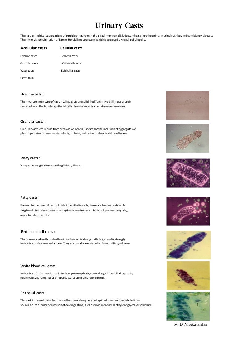 Urine casts &crystals