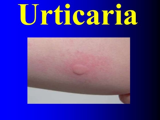 Urticaria (Hives) : causes, symptoms and treatments | PPT