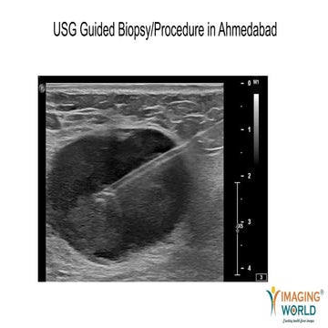 Usg guided biopsy procedure in ahmedabad | PDF