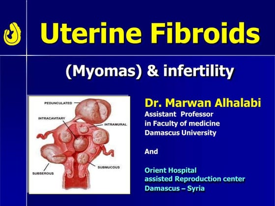 Myoma Uteri Presentation Uterine Fibroids Or Myomas Definition And