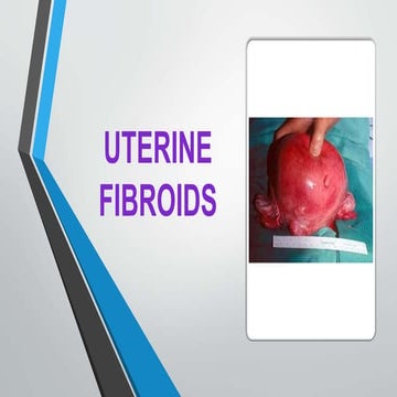 Uterine fibroids | PPTX