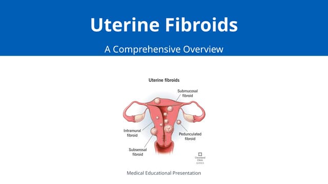 Uterine fibroids | PPTX