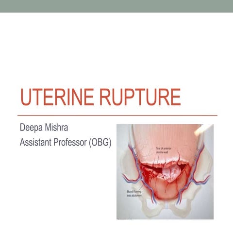 Rupture of the uterus | PPT