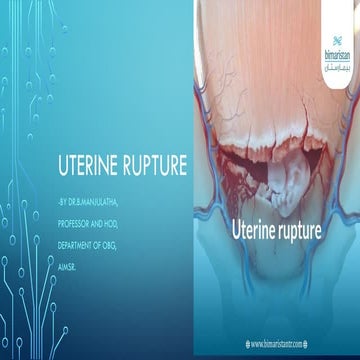 UTERINE RUPTURE.pptx uterine rupture in LSCS patient | PPTX
