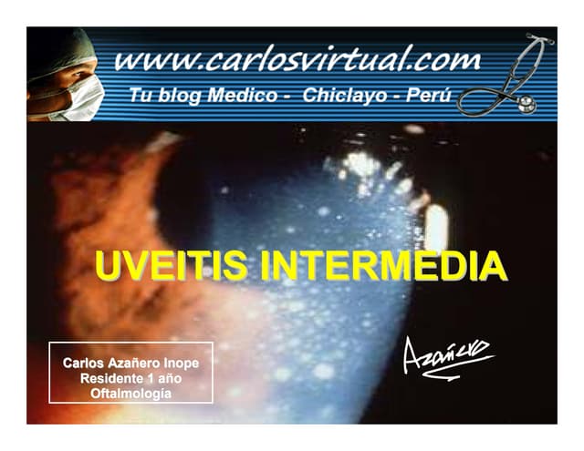 Intermediate uveitis | PPTX