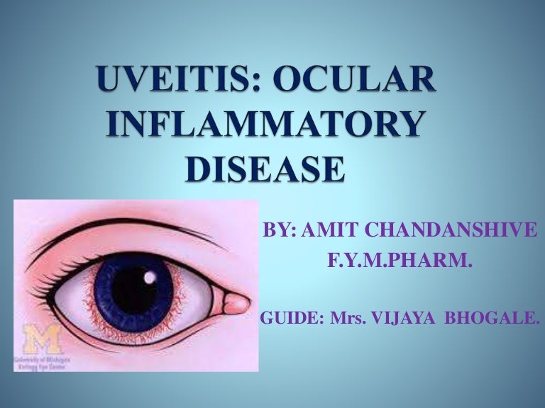 Uveitis ppt