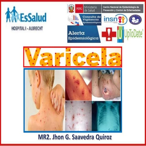 Varicela Perú - 2016 | PPTX