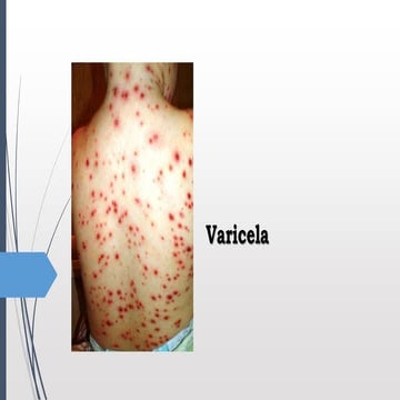 Varicela_en Pediatria_Practica 2023.pptx