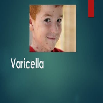 Penyakit Varicella a.k.a cacar air .pptx