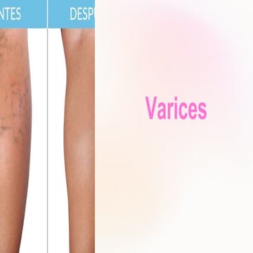 Varices que son por qué aparecen y su tratamiento.pptx