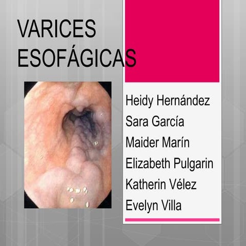 Varices esofágicas | PPTX