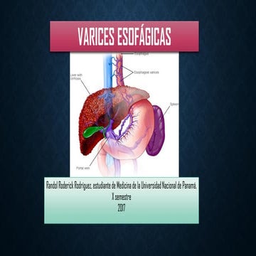 Anatomía De Las Varices Esofágicas
