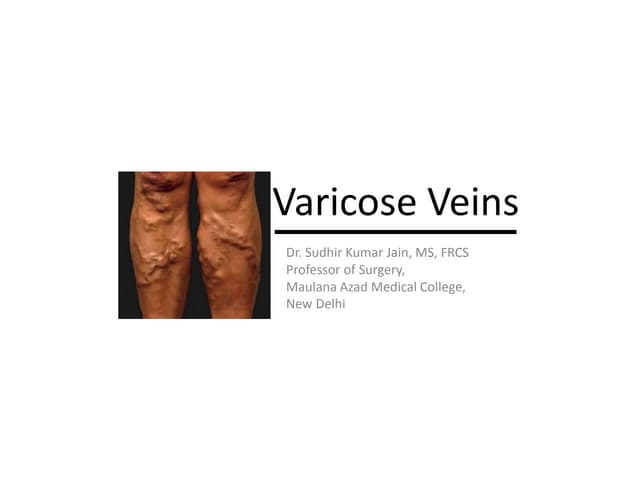 Case of Varicose Veins | PPTX
