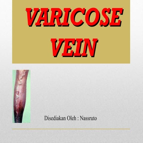 VARICOSE VEIN | PPT