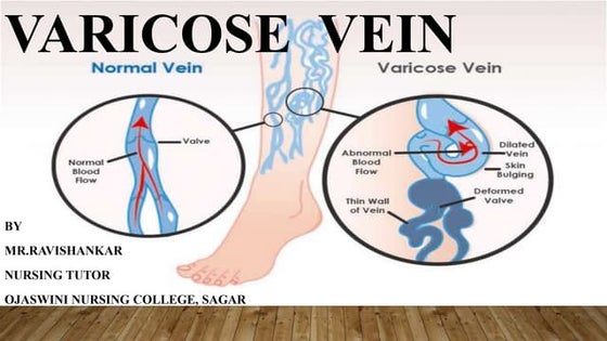 Varicose Veins Symptoms, Causes and Treatments | PPT