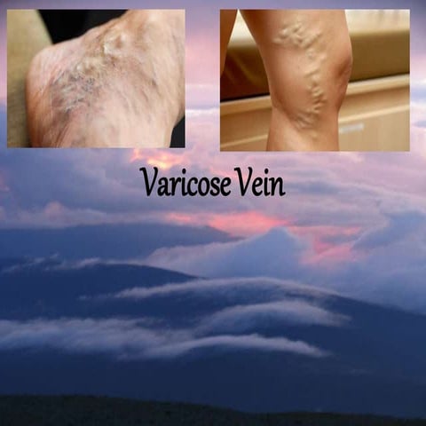 varicose vein.pptx