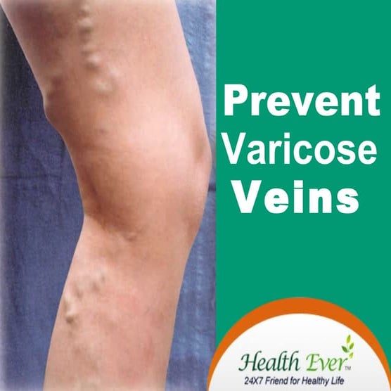 Prevent Varicose Veins | PPT